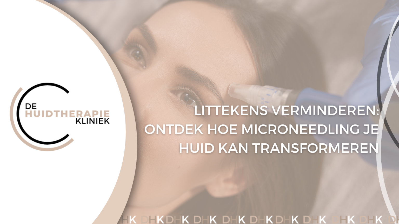Littekens verminderen - De Huidtherapie Kliniek Blog