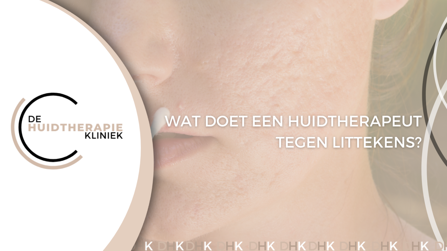 Wat doet een huidtherapeut tegen littekens?